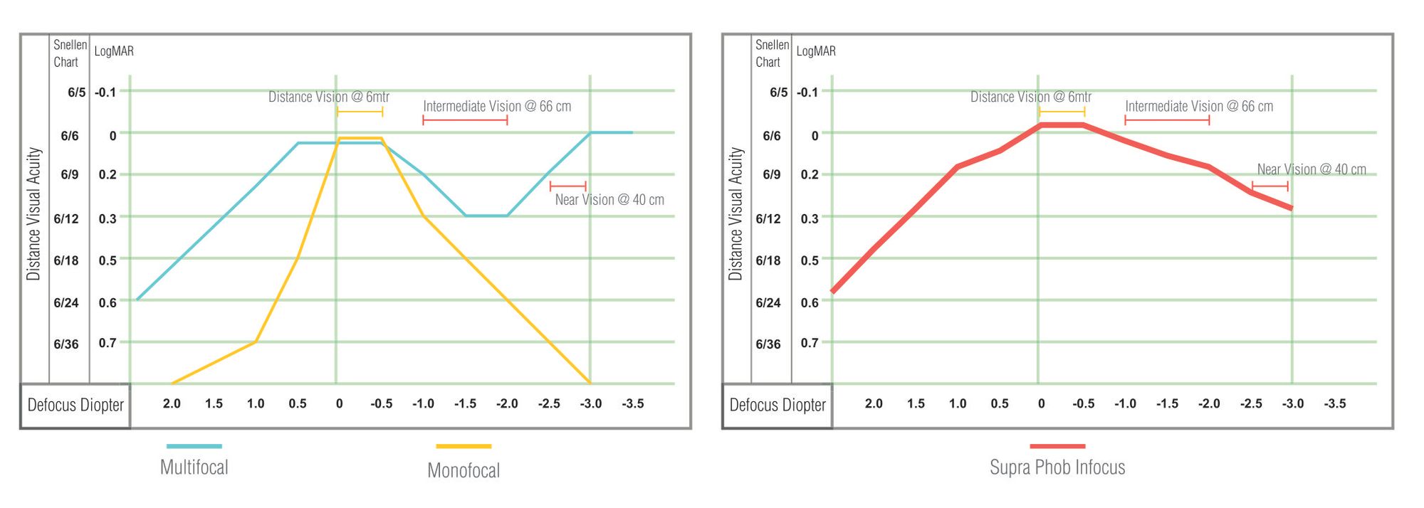 Supra Phob Infocus - Appasamy Hydrophobic Acrylic Lens/ Surgical IOL